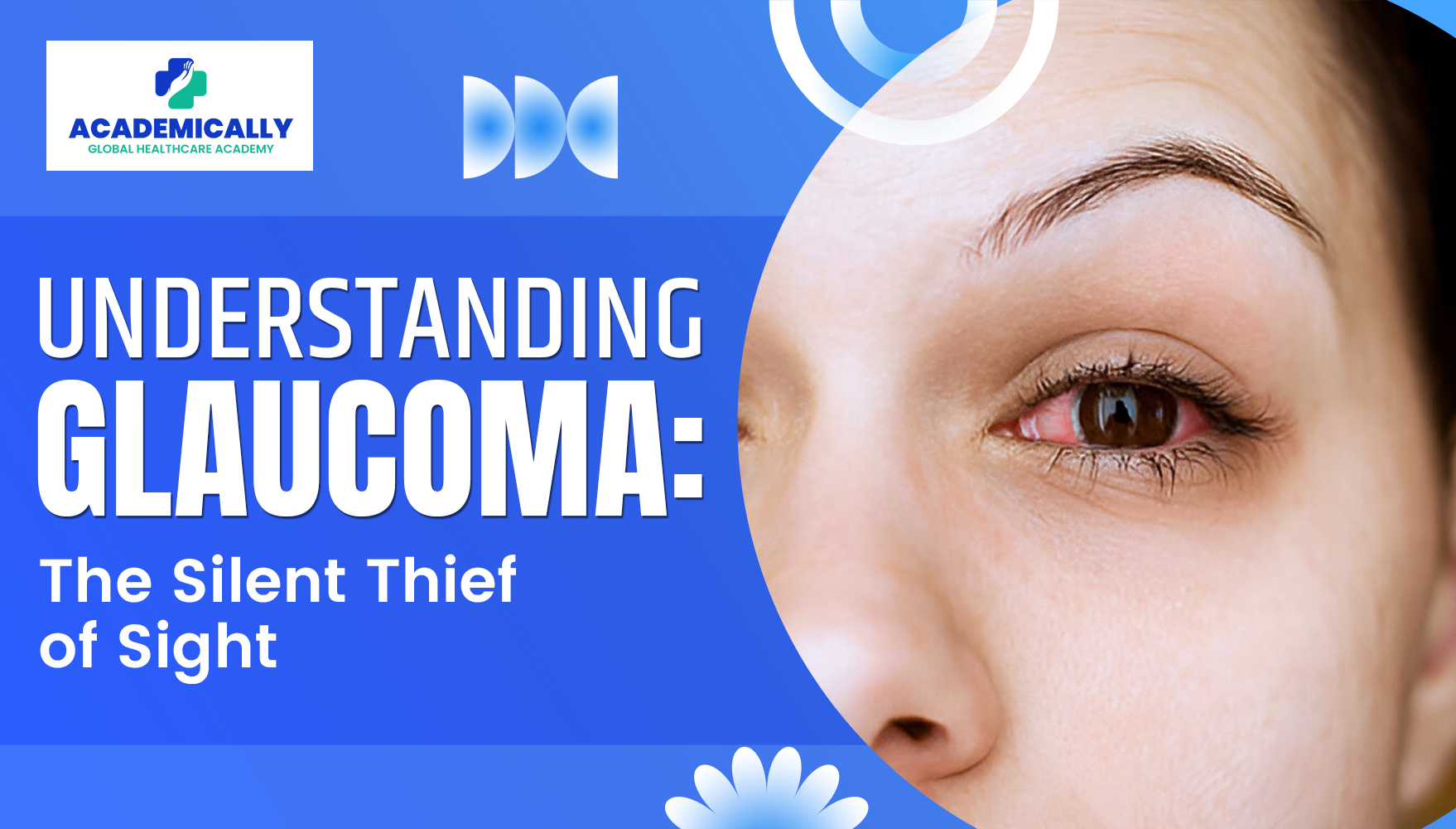 Understanding Glaucoma Silent Thief of Sight | Academically Global