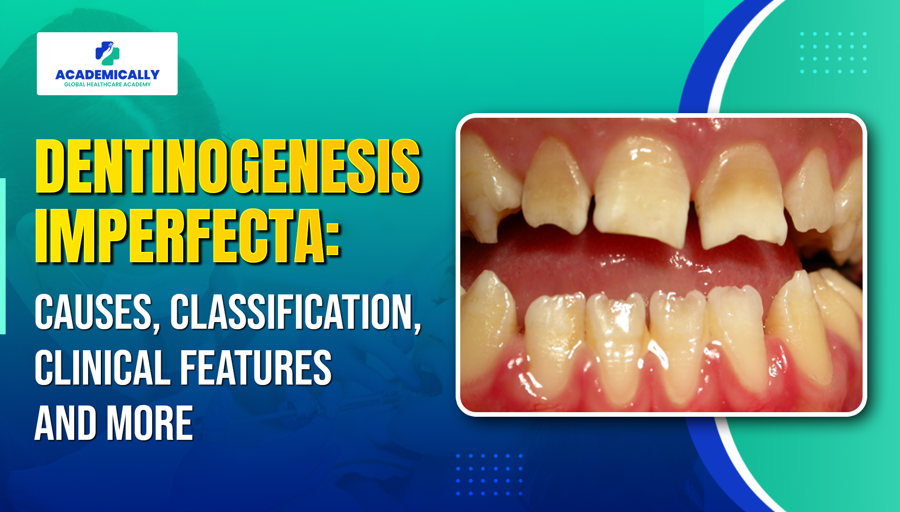 Causes, Classification & Clinical Features of Dentinogenesis Imperfecta ...